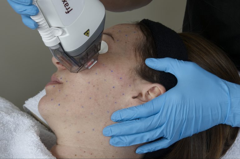 Fraxel Laser Review: Here's Everything You Need To Know